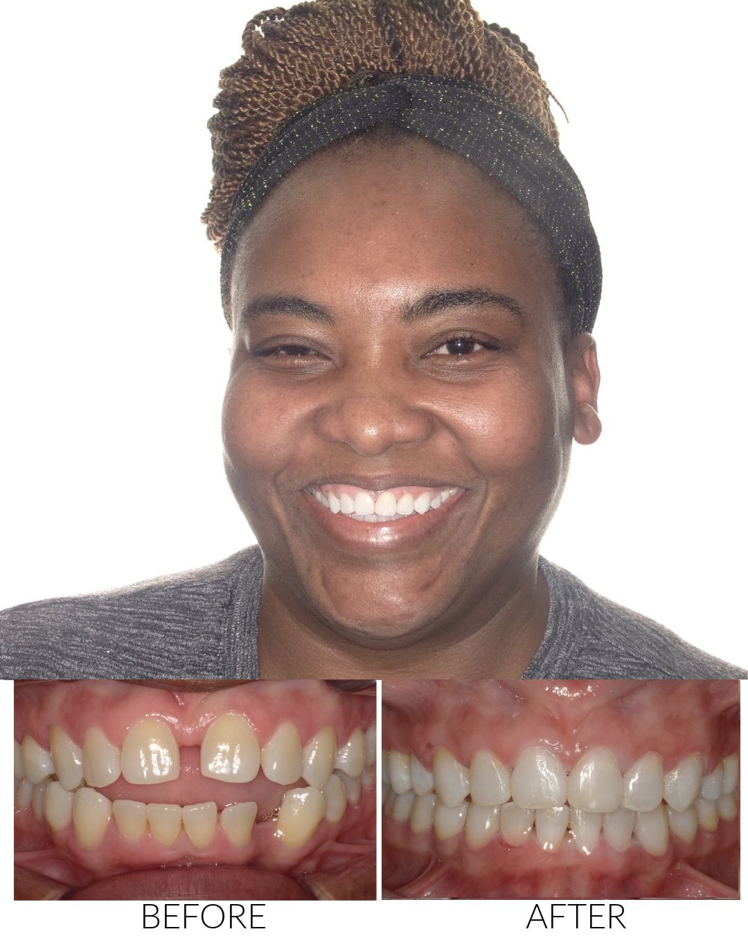 Hello Ortho Smile Model - Petaluma Copy | Hello Ortho