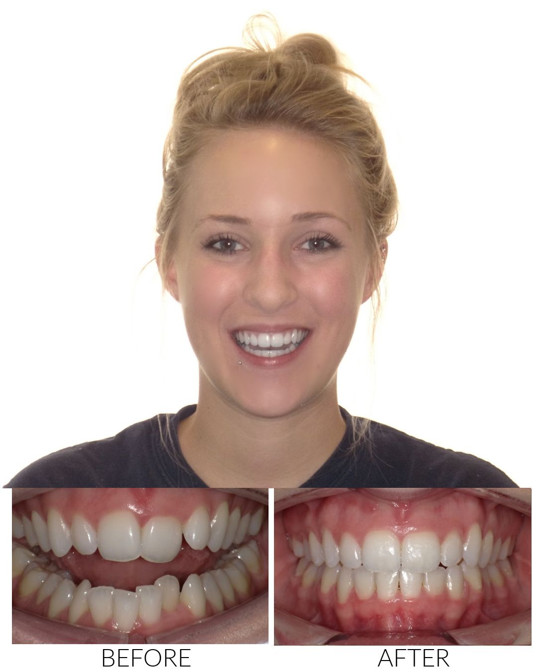 Hello Ortho Smile Model - Petaluma Copy | Hello Ortho